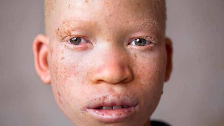 Le soleil est le même pour tous : le combat des personnes atteintes d ...